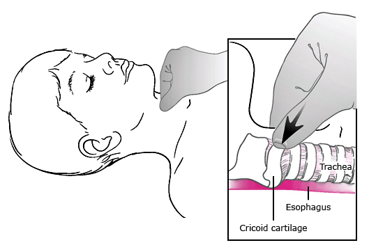 Rapid sequence induction and intubation(RSII) 신속 기관내삽관이 뭔가요? : 네이버 블로그