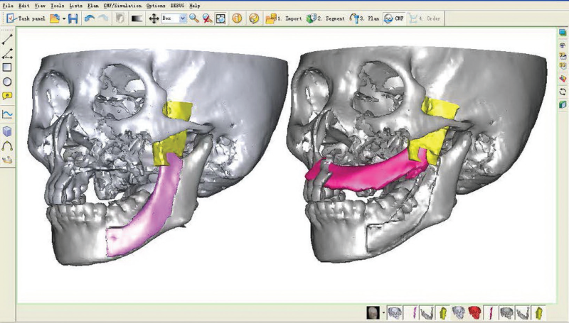 상악골 재건 방법 Maxillary Recon. Options : 네이버 블로그