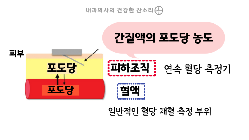 채혈하지 않고 혈당을 측정할 수 있다 무채혈 혈당 측정 연속 혈당 측정기 네이버 블로그