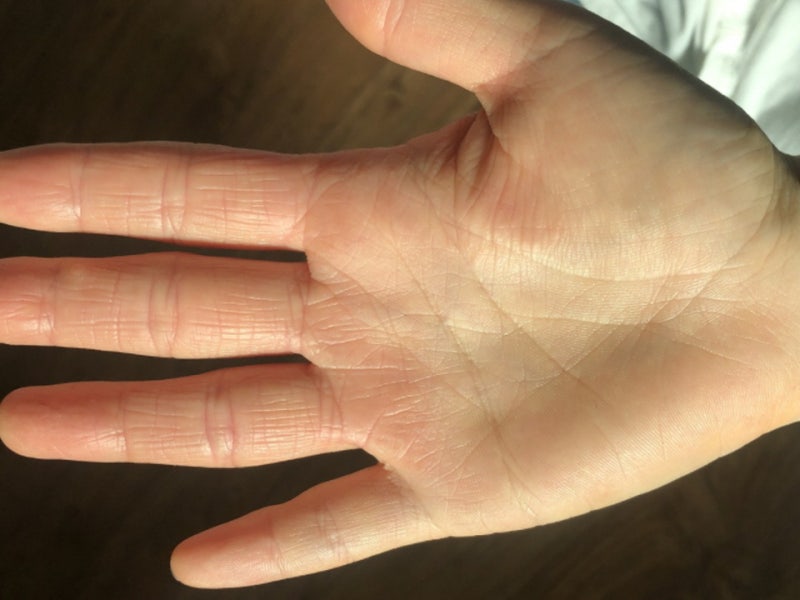 손가락 발바닥 한포진 원인 증상 생활 예방 수칙 지키자 네이버 블로그