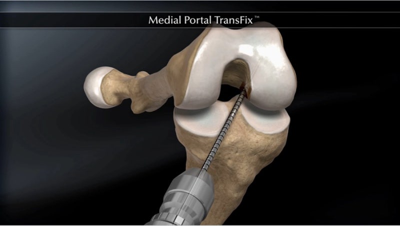ACL Medial Portal : TransFix : 네이버 블로그