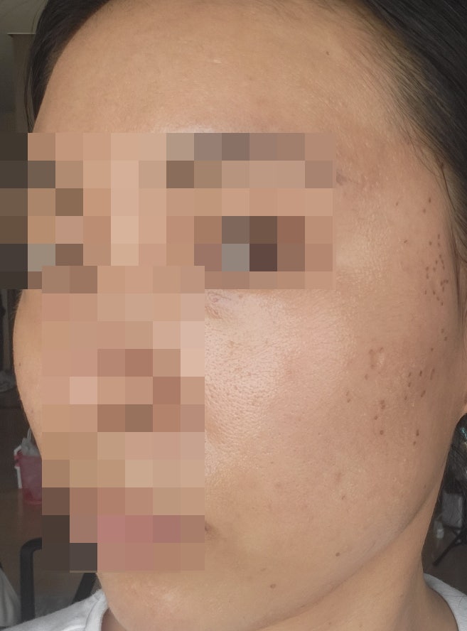 내돈내산 편평사마귀 제거 후기 네이버 블로그