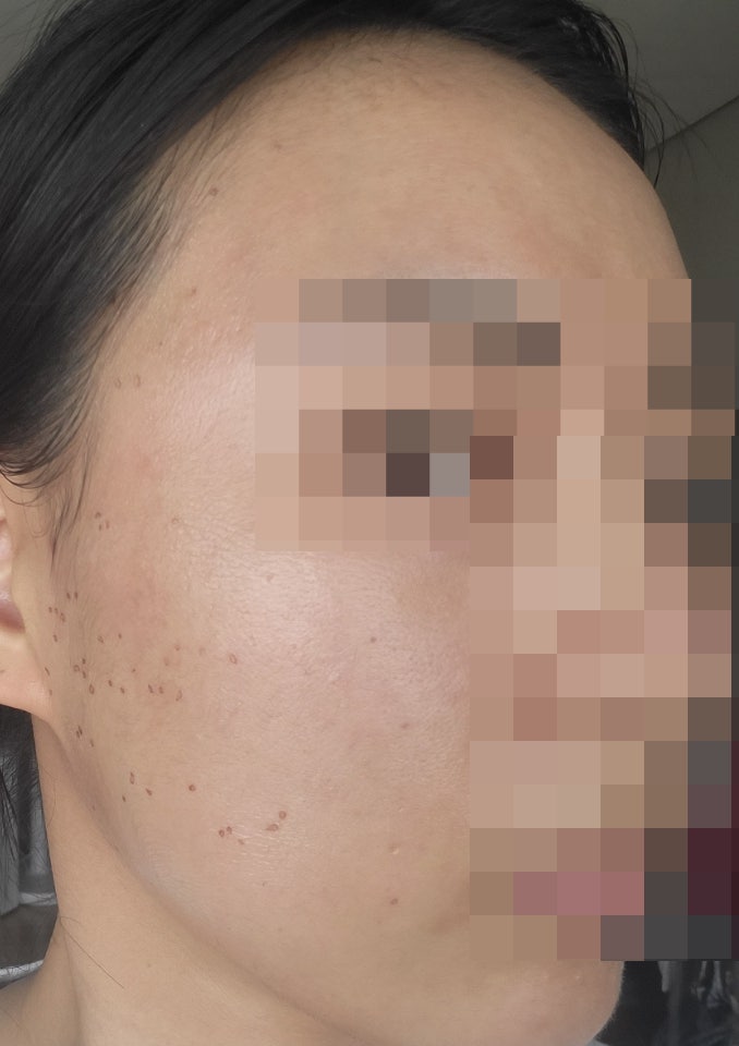 내돈내산 편평사마귀 제거 후기 네이버 블로그