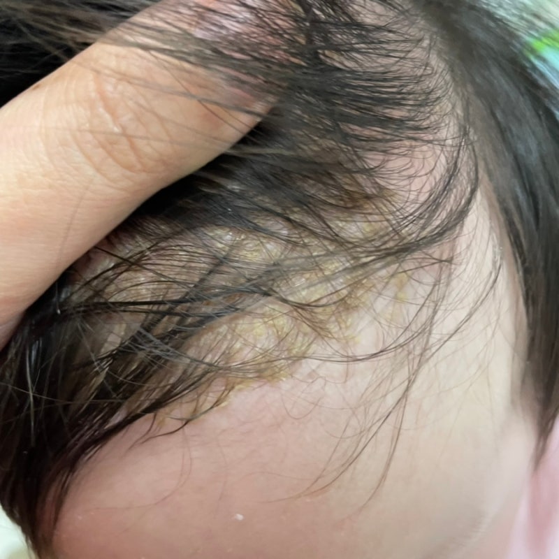 신생아 머리 각질 아기 두피 각질 원인 관리방법 간지러워할때 네이버 블로그