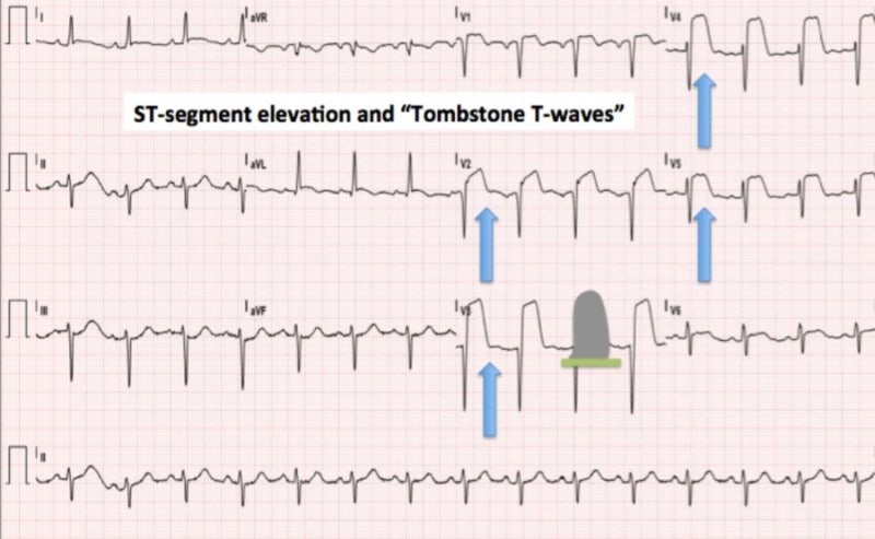묘석 심전도 tombstone ECG? : 네이버 블로그