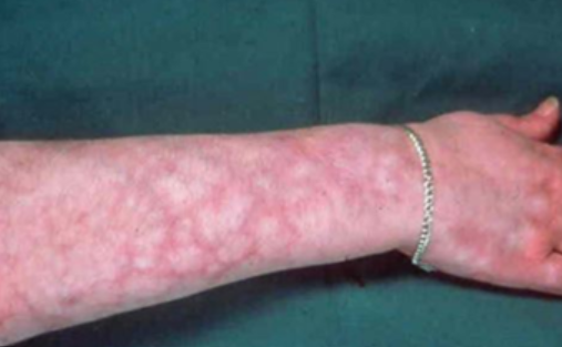 중환자 피부 반점(mottled skin, mottling sign) : 네이버 블로그