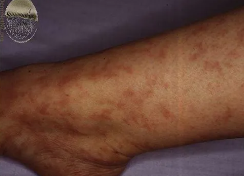 중환자 피부 반점(mottled skin, mottling sign) : 네이버 블로그