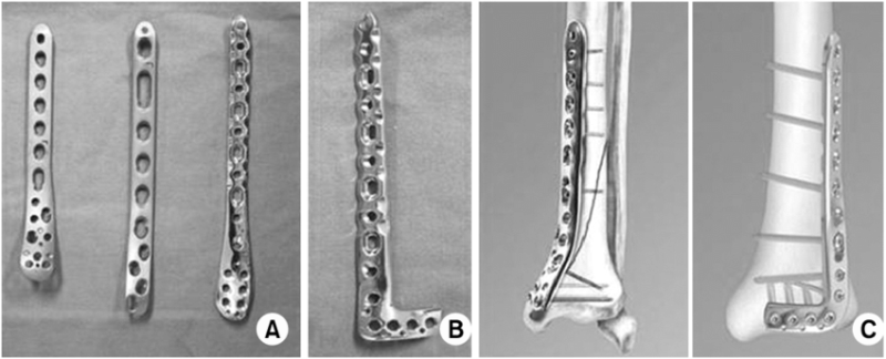 Bimalleolar ORIF (AO) : 네이버 블로그