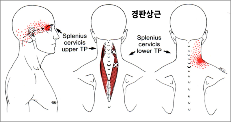 관자놀이 통증 옆머리 두통 유발 근육 긴장성 두통 원인 근육 네이버 블로그