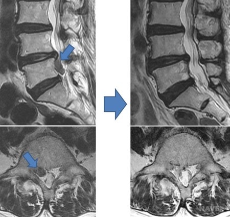 [NS수술] PELD(Percutaneous Endoscopic Lumbar Discectomy, 경피적 내시경 추간판 절제술 ...