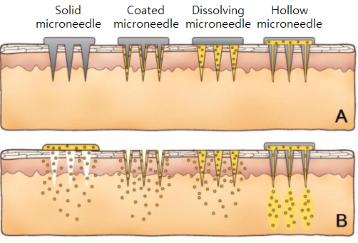 마이크로니들 (Microneedle)의 모든 것 : 네이버 블로그