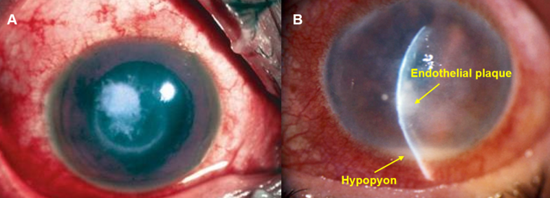 Eye잘보여 진균 각막염fungal Keratitis 2 임상양상 증상 진단검사 염색검사 배양검사