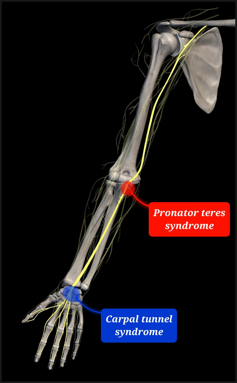 1~4번째 손가락 저림 : 원회내근 증후군(pronator teres syndrome) 검사 : 네이버 블로그