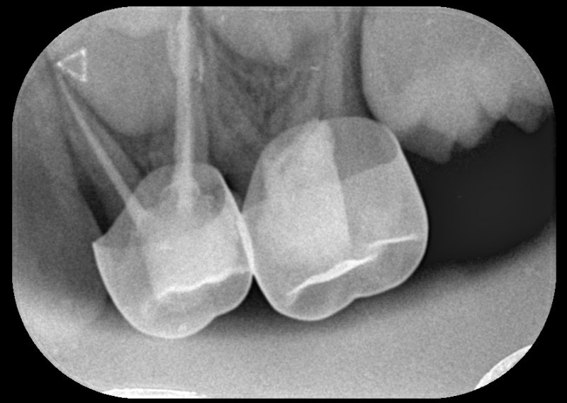 유치 MTA pulpotomy 신경치료(치수절단술) 2년 예후 및 성공률 : 네이버 블로그