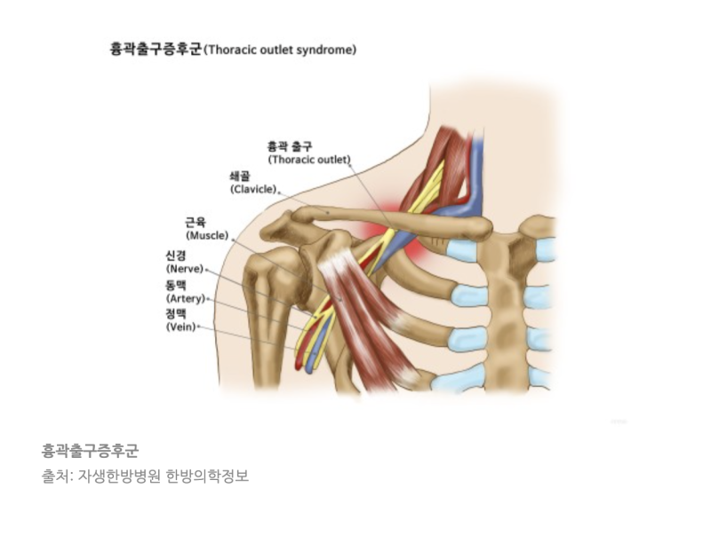 흉곽출구증후군 총정리 원인 증상 치료 예방법 네이버 블로그