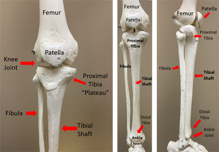 Proximal Tibia ORIF (AO) : 네이버 블로그