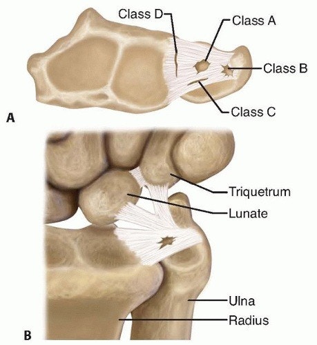[OS수술] Wrist A/S TFC(Triangular Fibrocartilage Complex) Repair : 네이버 블로그