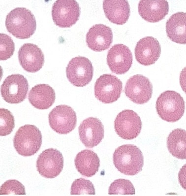 적혈구 형태 이상 | 크기 | 염색성 | 봉입체 | 분포 : 네이버 블로그