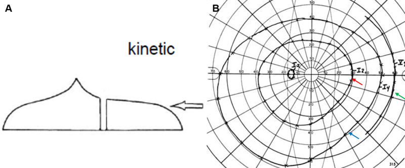 [EYE잘보여] 시야(Visual field)란, 어둠의 바다에 떠있는 '시력의 섬' - 시야의 측정과 시야에 영향을 주는 ...
