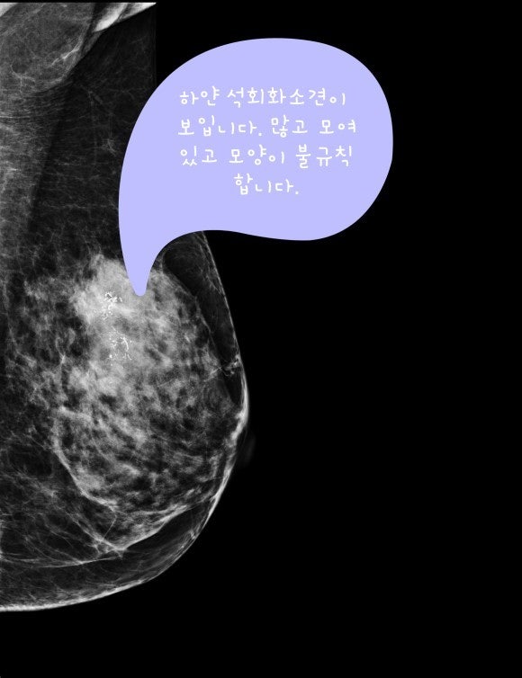 군집된 미세석회화소견유방암 0기 상피내암 제자리암의 진단 종류 치료 예후 분당 위드심 김미혜원장 전김미혜유클리닉원장