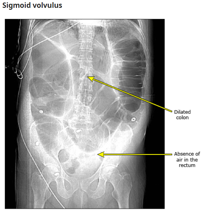Sigmoid volvulus : 네이버 블로그