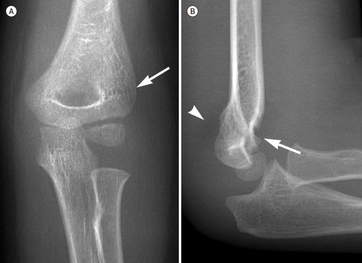 팔꿈치 소아의 정상 팔꿈치 X Ray 과상부 골절supracondylar Fx 외 부위 네이버 블로그