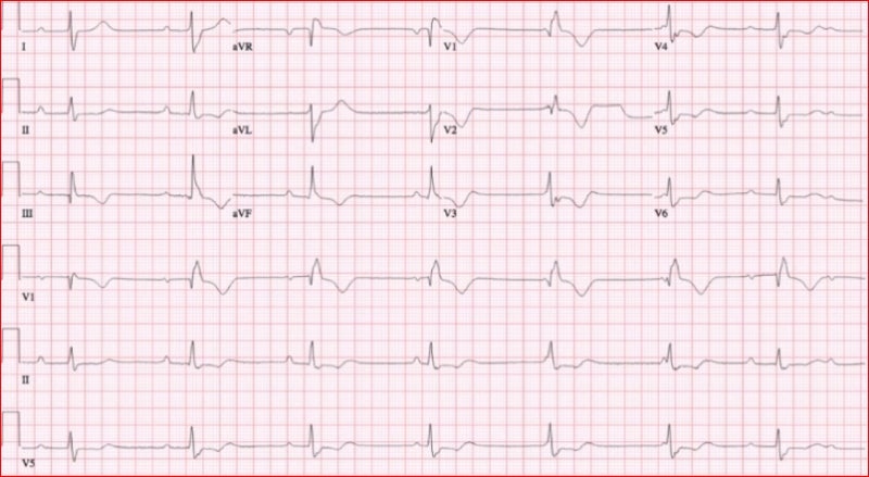 완전방실차단, Complete heart block [차이점 : High degree AV block] : 네이버 블로그
