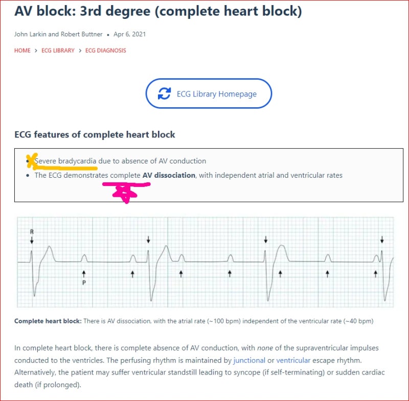 완전방실차단, Complete heart block [차이점 : High degree AV block] : 네이버 블로그