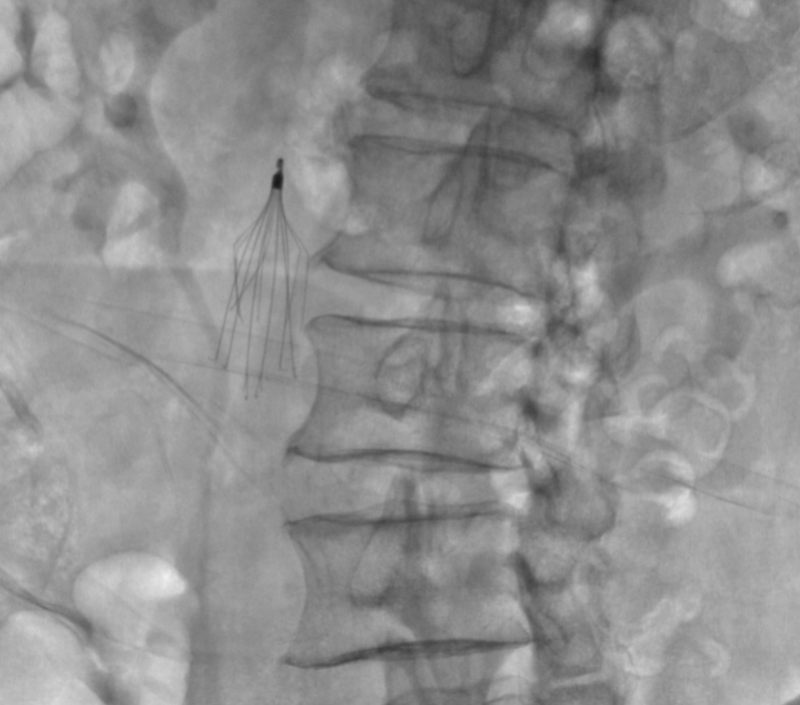 DVT 환자 IVC filter ( inferior vena cava ) 하대정맥 필터 공부하기 : 네이버 블로그