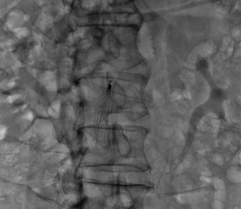 DVT 환자 IVC filter ( inferior vena cava ) 하대정맥 필터 공부하기 : 네이버 블로그