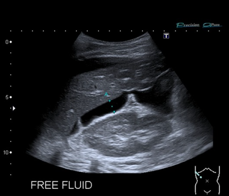 Ovarian hyperstimulation syndrome(OHSS,난소과자극증후군) : 네이버 블로그