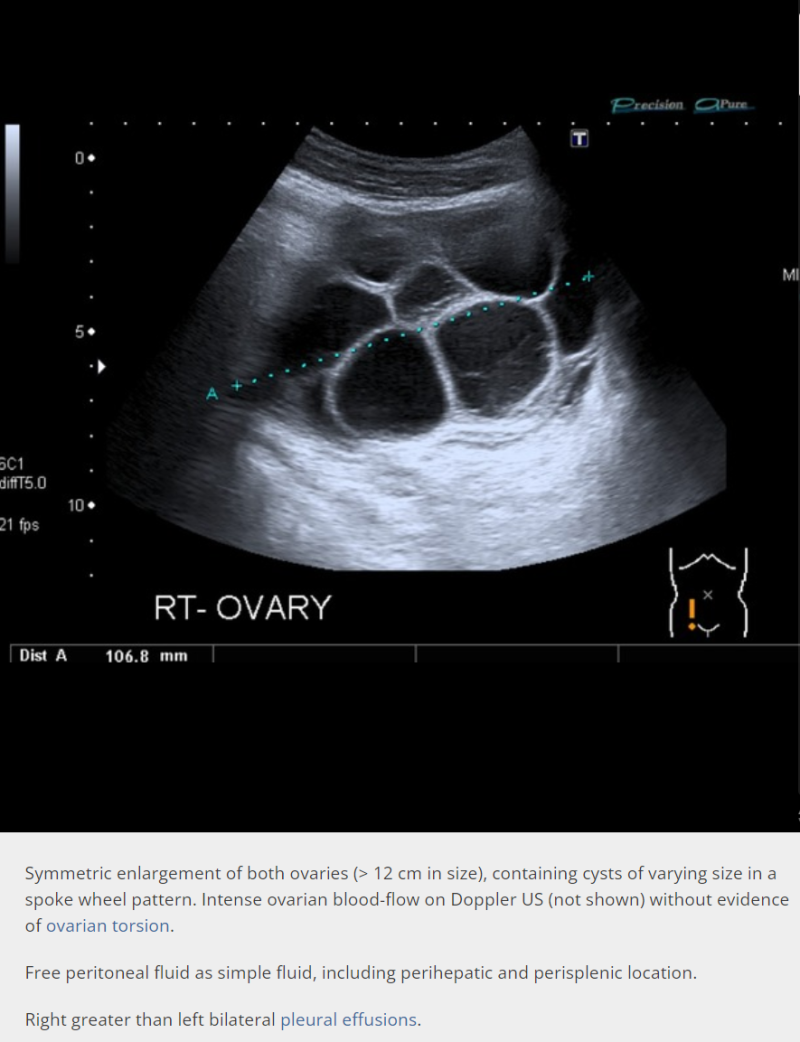 Ovarian hyperstimulation syndrome(OHSS,난소과자극증후군) : 네이버 블로그