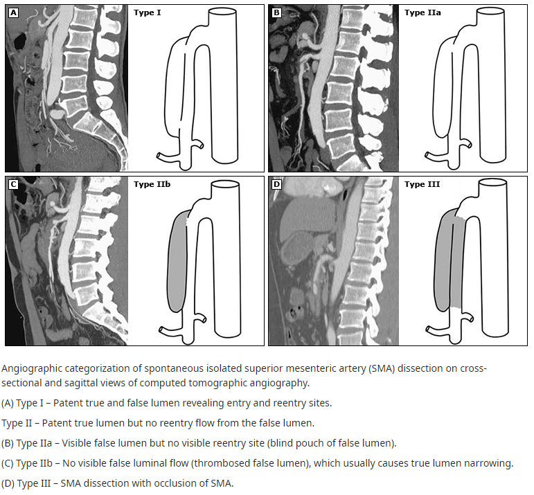 31. SMA(superior mesenteric artery) dissection 상장간막 동맥 박리 : 네이버 블로그