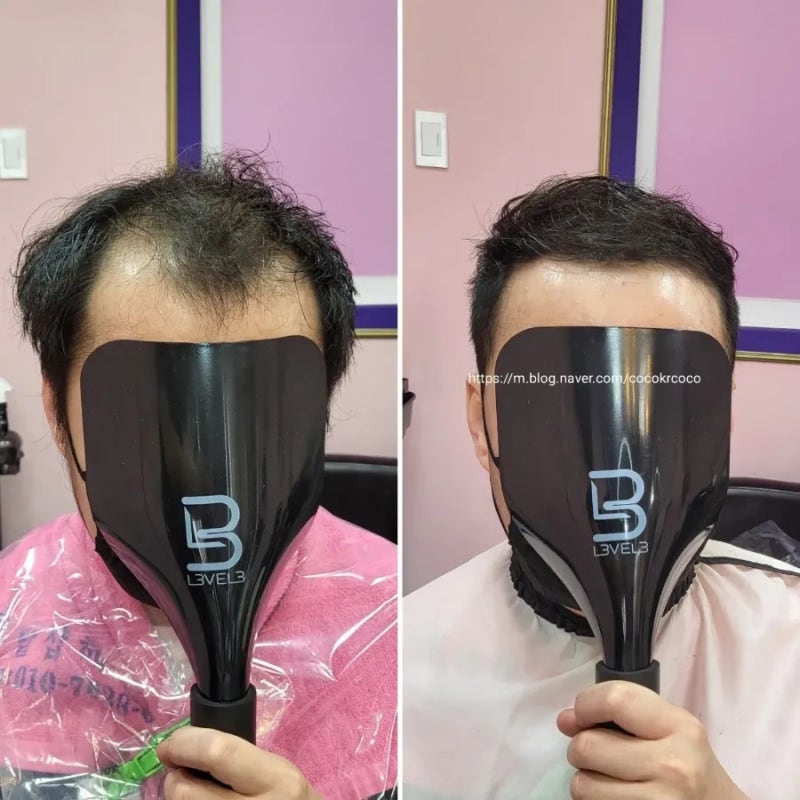 대구에서 평택증모전문 용이동미용실 헤어공감을 찾아 주신고객님의 헤어증모술 시술사례 입니다 네이버 블로그
