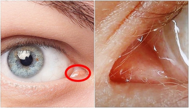 눈 안쪽 부음 현상 왜일어 나는지 원인과 해결 방법은 네이버 블로그