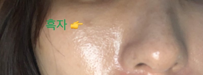 피코슈어 토닝 후기 1차 내돈내산 솔직 후기 흑자 기미 잡티 제거 맞춤 집중 치료 피부과 레이저 시술 전후