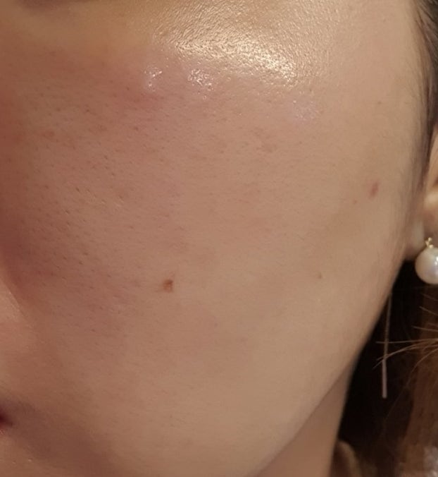 성형외과 간호사가 스킨부스터 직접 맞아봤다 엑소텐 줄기세포주사 네이버 블로그