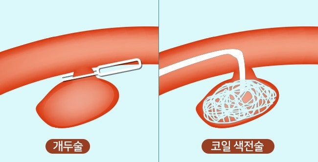 비파열성 뇌동맥류코일색전술 후기산정특례30대 뇌혈관질환 네이버 블로그