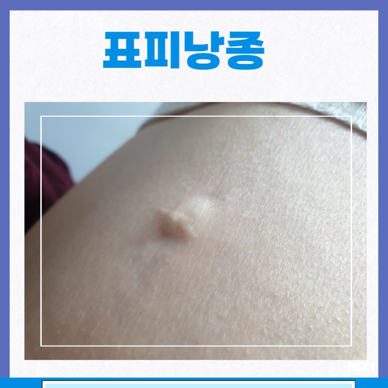 표피낭종 원인 증상 진단 치료 수술 비용 예방 네이버 블로그