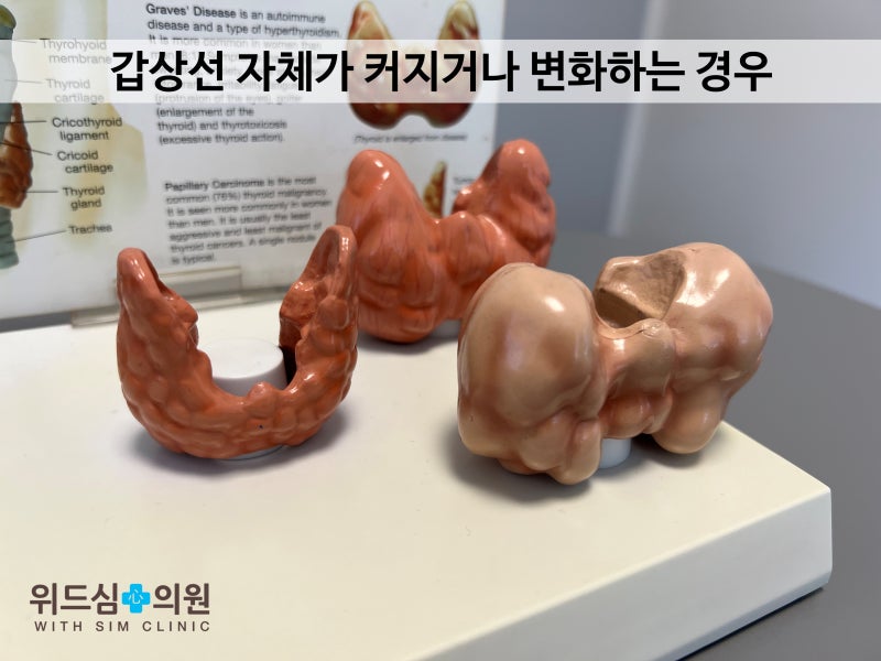 건강검진 갑상선 초음파검사로 알게 된 혹 결절 병원에서 정밀검사를 받는 것이 도움 되는 경우와 재검사가 언제 필요한지