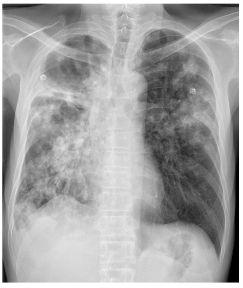 활동성 폐결핵 폐엑스레이 사진 증례 공동 Pleural Thickening 흉막 삼출 Pleural Effusion