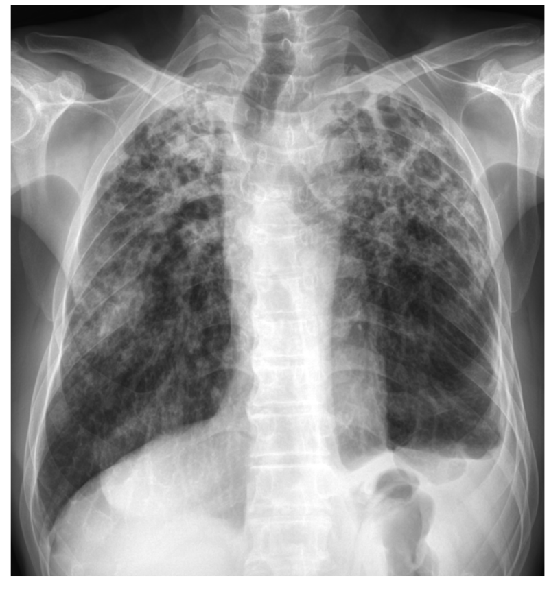 활동성 폐결핵 폐엑스레이 사진 증례 공동 Pleural Thickening 흉막 삼출 Pleural Effusion