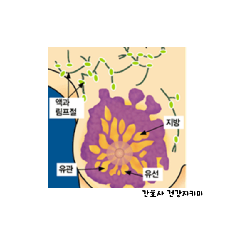 유방암 수술 후 간호 및 운동방법과 림프부종 예방법 네이버 블로그