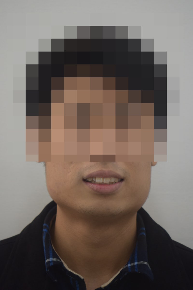 2급 부정교합 발치 교정 을 해야 되는 기준을 알려드립니다 네이버 블로그