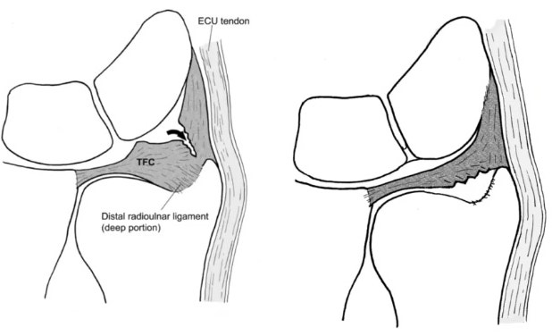 [정형외과 전문의] 손목 삼각섬유연골 복합체 손상 (TFCC lesion, injury, Ulnar impaction SD ...