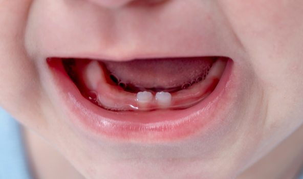 아이 입안에 뭐가 났어요! (선천지, 신생치, Bohn's nodule, Epstein's pearl) : 네이버 블로그