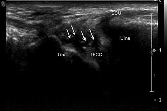 인천 연수 통증의학과 - 손목 바깥쪽의 통증과 주사 요법 (Feat. TFCC tear, 프롤로, PDRN, 리젠씰) : 네이버 블로그