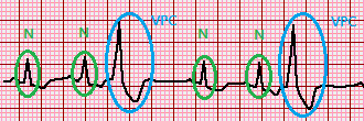 심실조기박동(prematrue ventricular complex) : 네이버 블로그