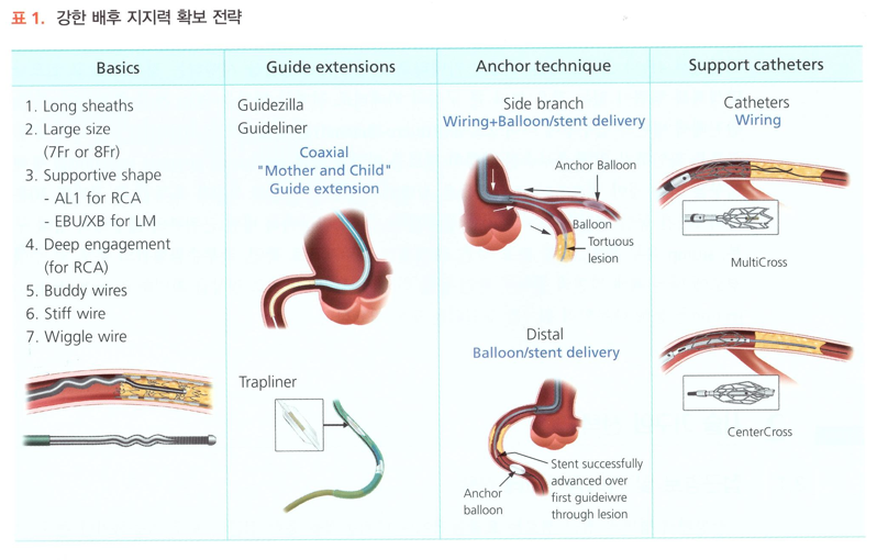 만성폐색병변(CTO)- 전향적 접근법(Antegrade Approach)을 이용한 시술 - 접근경로 및 가이딩카테터 선택 ...