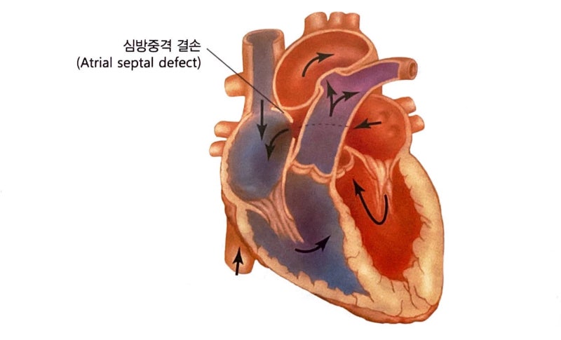 아동간호학 건강 회복 심혈관 문제 청색증좌우단락동맥관개존증심방중격결손심실중격결손우좌단락팔로4징후삼첨판폐쇄